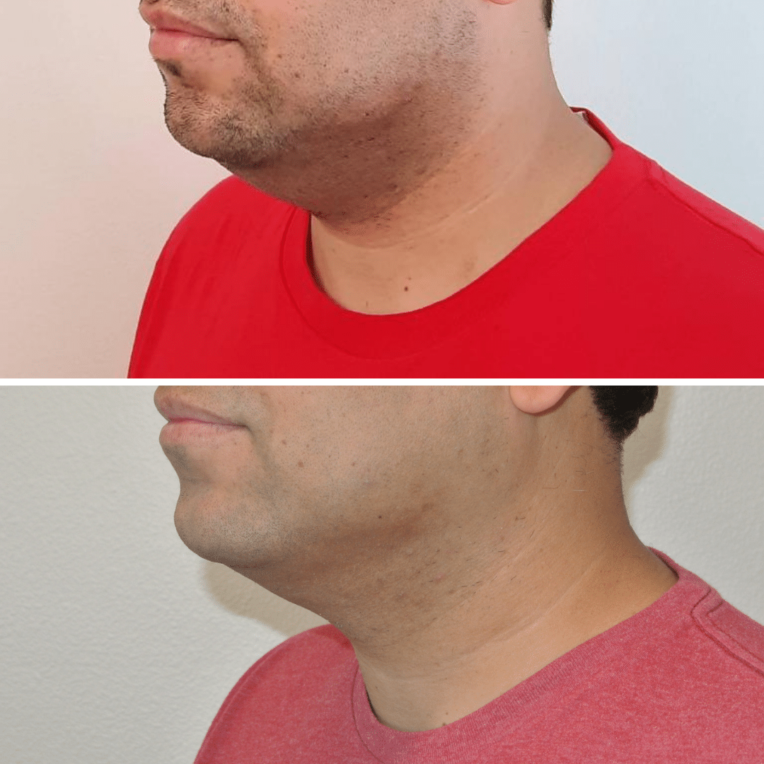 Seto Plastic Surgery Before And After In Winter Park, Fl