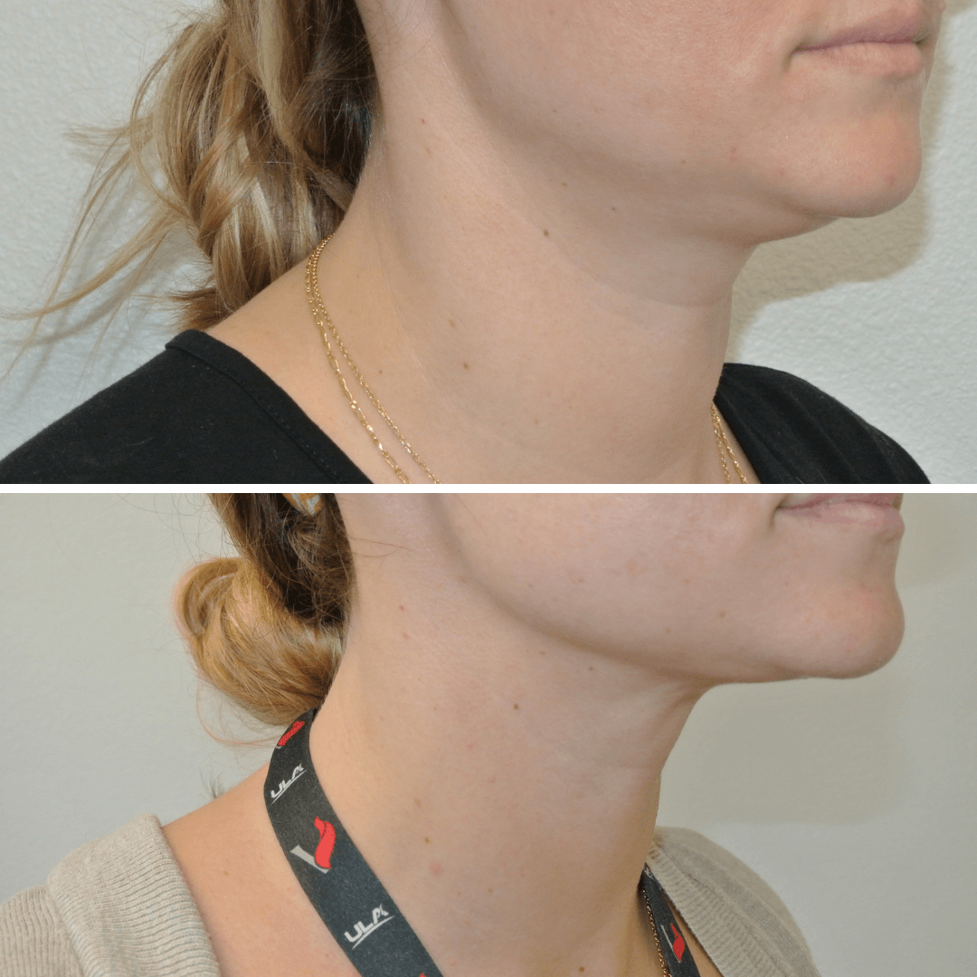 Seto Plastic Surgery Before And After In Winter Park, Fl