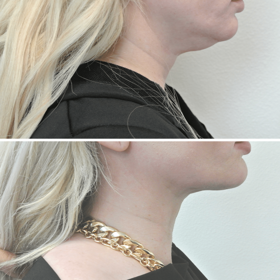 Seto Plastic Surgery Before And After In Winter Park, Fl