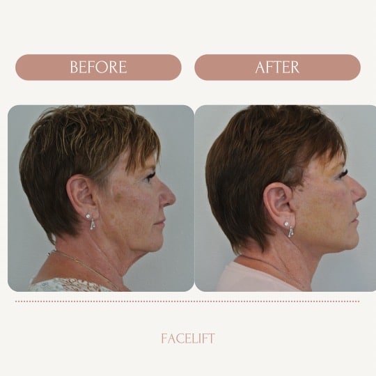 Seto Plastic Surgery Before And After In Winter Park, Fl