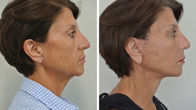Seto Plastic Surgery Before And After In Winter Park, Fl