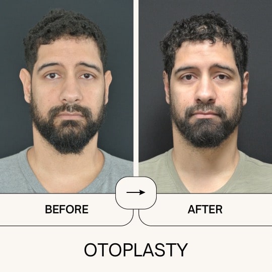 Seto Plastic Surgery Before And After In Winter Park, Fl