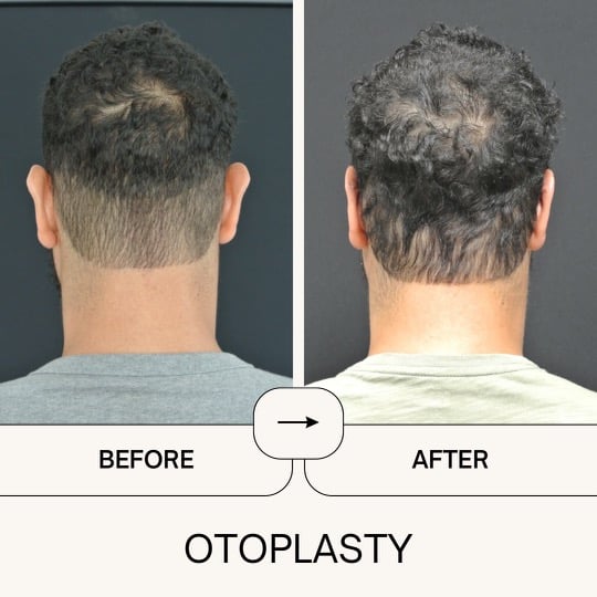 Seto Plastic Surgery Before And After In Winter Park, Fl